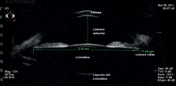 Ultrabiomicroscopía (UBM) - Centro de Ojos San IsidroCentro de Ojos San ...